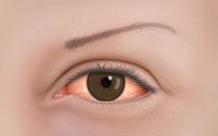 Causas y tratamiento para los ojos rojos - La Guía de las Vitaminas