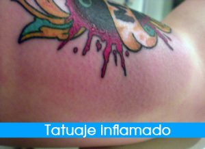 Cómo Saber Si Un Tatuaje Esta Infectado (Nunca Lo Ignores)