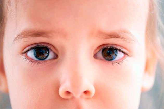 Conjuntivitis: qué es, causas, signos, síntomas y tratamiento - La Guía ...