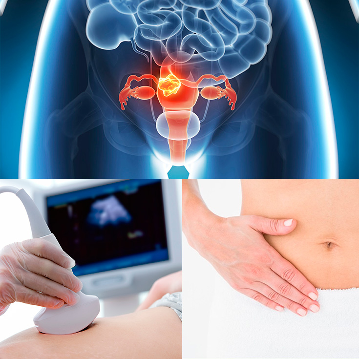 Miomas Uterinos: Causas, Síntomas Y Tratamiento - La Guía de las Vitaminas