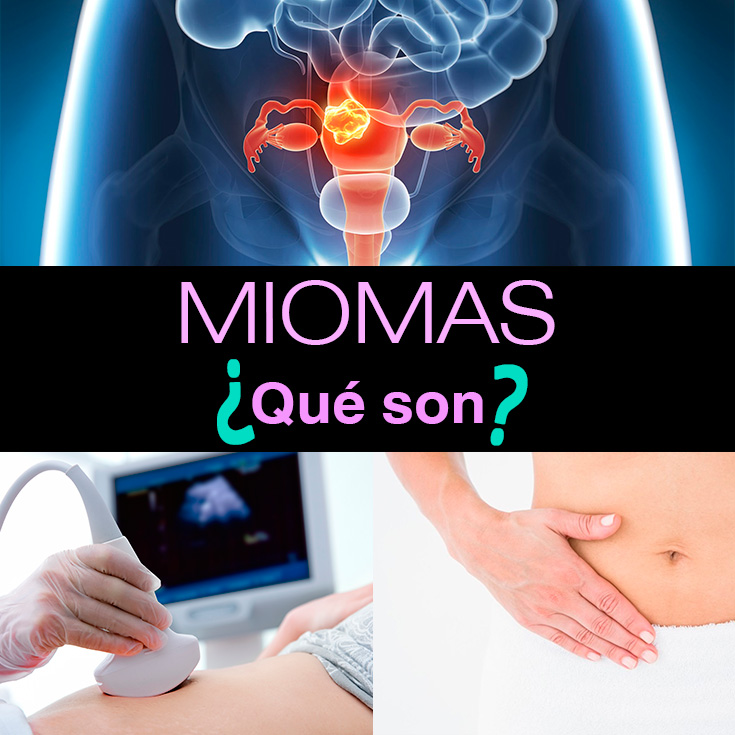 Miomas Uterinos: Causas, Síntomas Y Tratamiento - La Guía de las Vitaminas