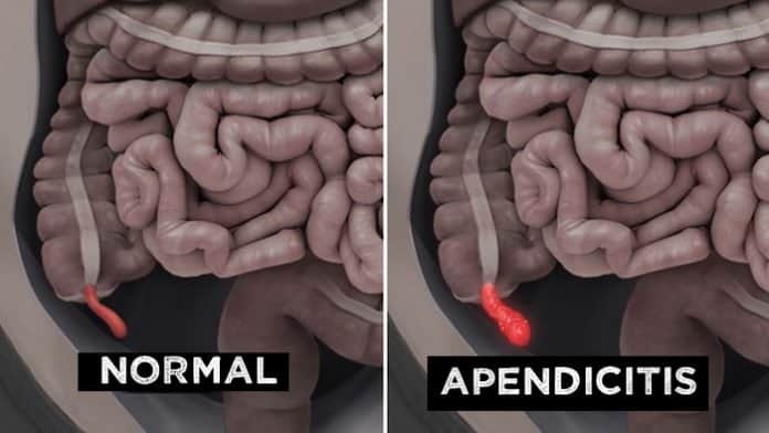 ¿Porqué da la apendicitis?, síntomas y como se trata - La Guía de las ...