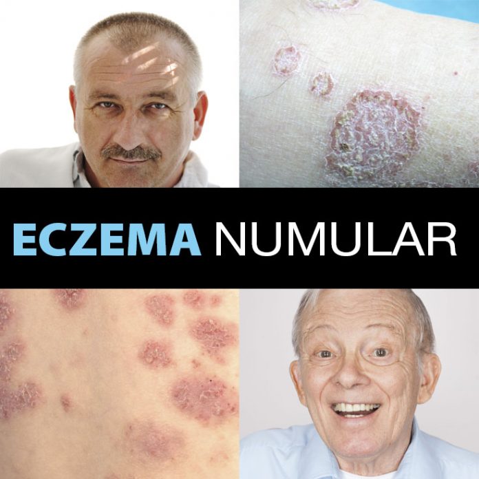 Eczema numular: causas, síntomas, diagnóstico y tratamiento - La Guía ... Eczema numular: causas, síntomas, diagnóstico y tratamiento - La Guía ...