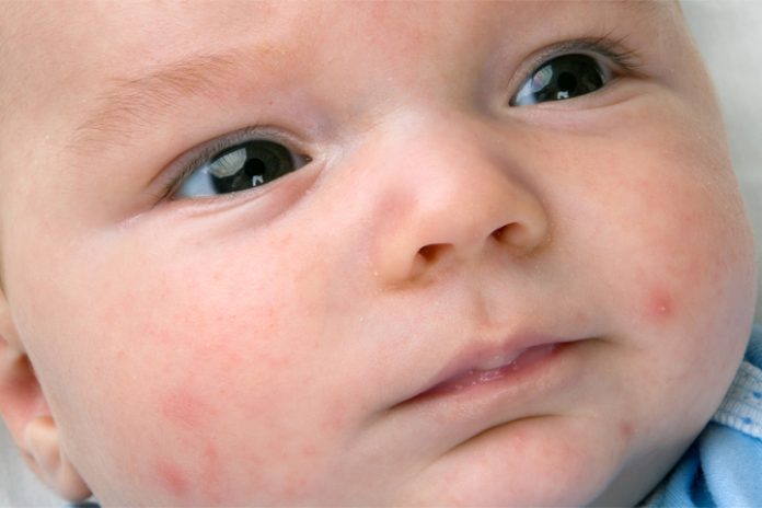 Eczema: causas, tipos, síntomas y tratamiento - La Guía de las Vitaminas