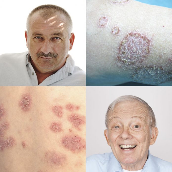 Eczema numular: causas, síntomas, diagnóstico y tratamiento - La Guía ...