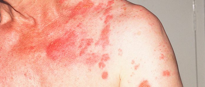 Erupción cutánea: causas, fotos, tipos y tratamiento - La Guía de las ...