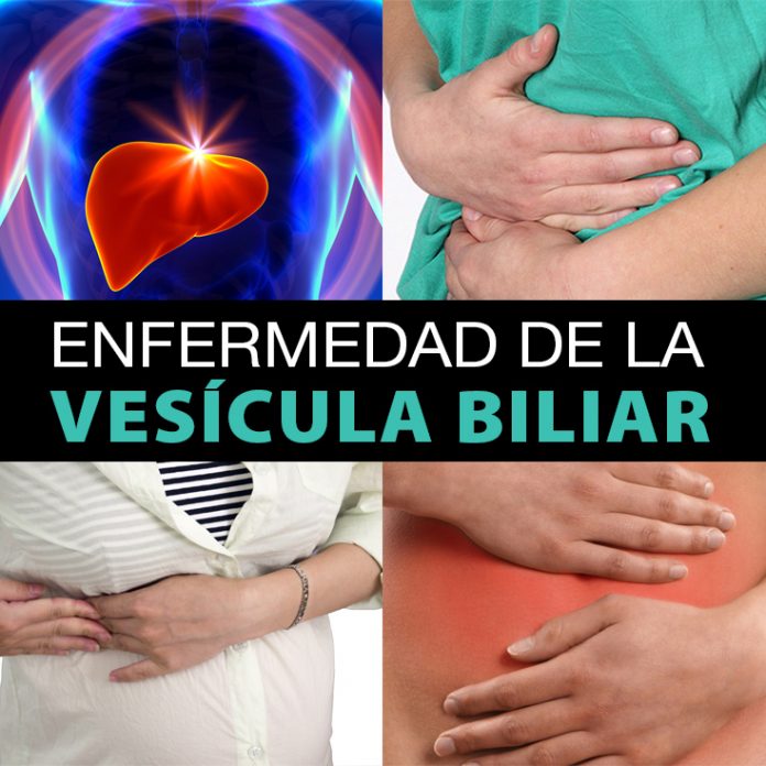 Enfermedad de la vesícula biliar: tipos, diagnóstico y tratamiento - La ...