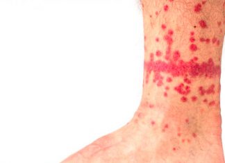 Picadura De Pulga En Humanos: Síntomas Y Tratamientos - La Guía de las ...