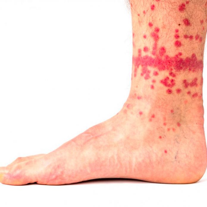 Picadura de pulga en humanos: cómo identificar, síntomas, riesgos y ...