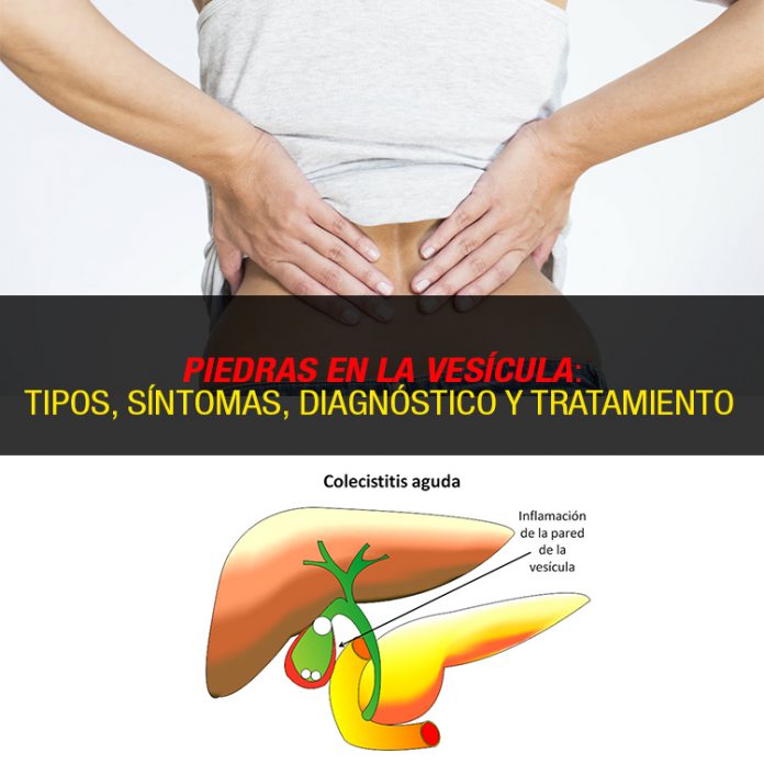 Piedras en la vesícula: causas, peligros, síntomas, diagnóstico y ...