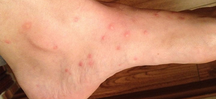 Picadura de pulga en humanos: cómo identificar, síntomas, riesgos y ...