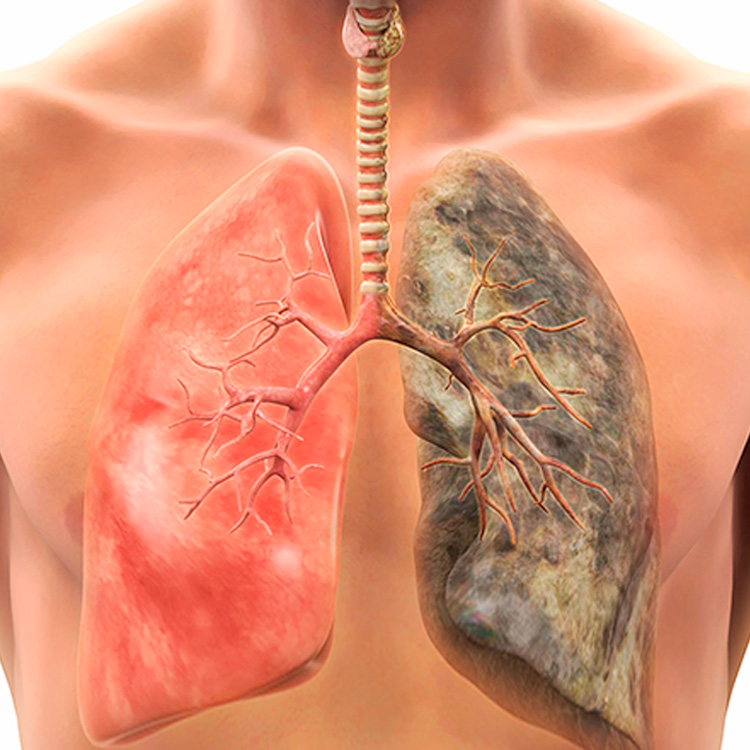 Cómo se diferencia un pulmón de un fumador comparado con un pulmón ...