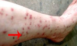 Picadura de pulga en humanos: cómo identificar, síntomas, riesgos y ...
