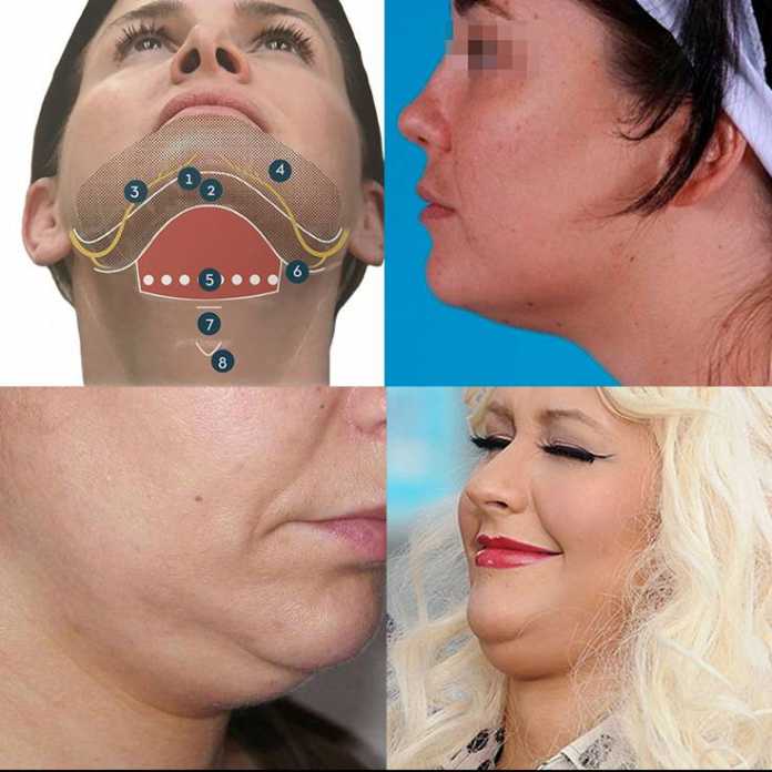 Cirugía de papada o liposucción de papada: qué es, cómo se hace y ...