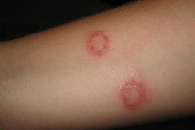 Infecciones en la piel: tipos, causas, síntomas y tratamientos - La ...