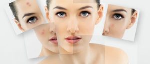 Las mejores pastillas para quitar el acné - La Guía de las Vitaminas