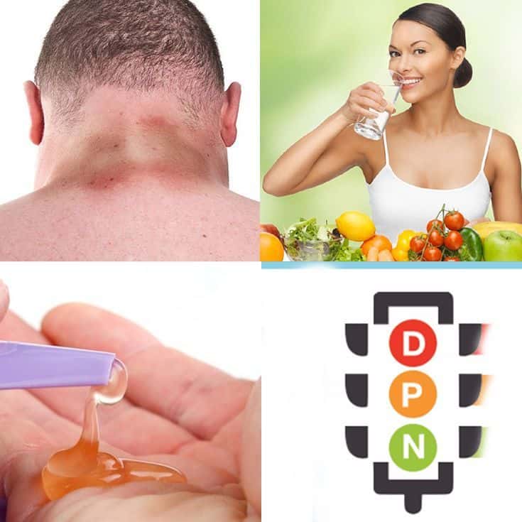 Acantosis nigricans: causas, síntomas y tratamiento - La Guía de las ...