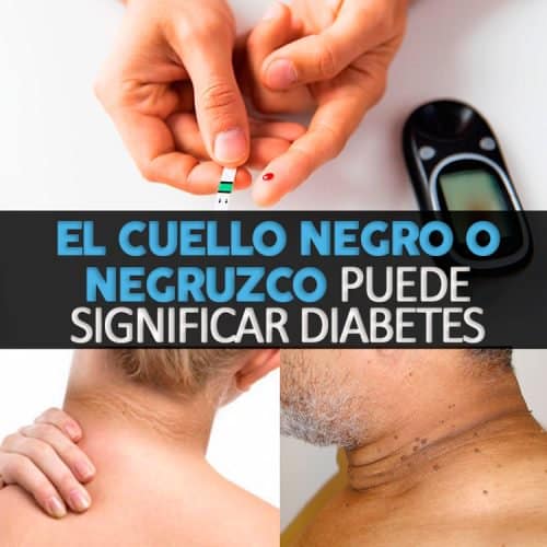 ¿El cuello negro o negruzco significa que tienes diabetes tipo 2? - La ... ¿El cuello negro o negruzco significa que tienes diabetes tipo 2? - La ...