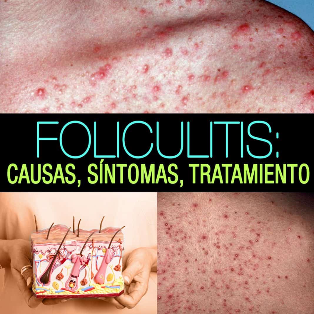 Foliculitis: causas, síntomas, tratamiento y complicaciones - La Guía ...