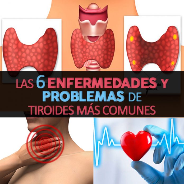 Las 6 enfermedades y problemas de tiroides más comunes - La Guía de las ...