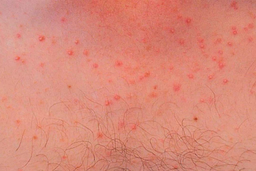 Foliculitis: causas, síntomas, tratamiento y complicaciones - La Guía ...