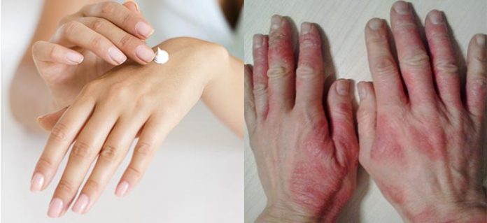 Erupción cutánea: causas, fotos, tipos y tratamiento - La Guía de las ...