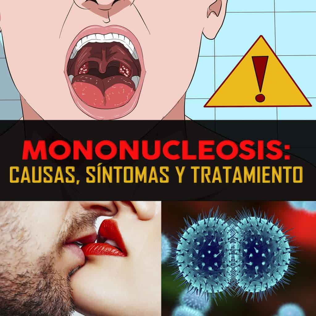 Mononucleosis: causas, síntomas y tratamiento - La Guía de las Vitaminas