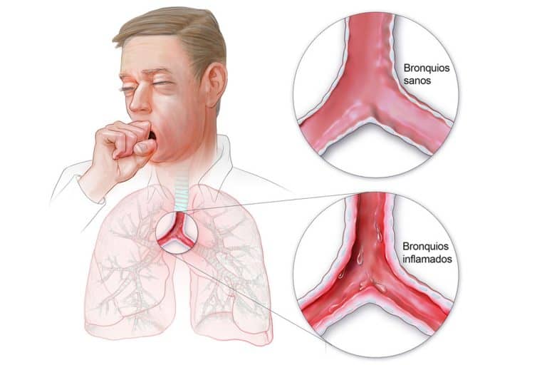 Flema verde, amarilla o café: ¿Qué significa los diferentes tipos de ...