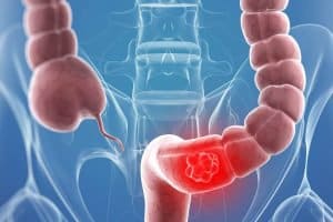 Pólipos en el colon: causas, síntomas y tratamiento - La Guía de las ...