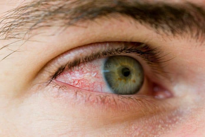 Derrame ocular: causas, síntomas y tratamiento - La Guía de las Vitaminas