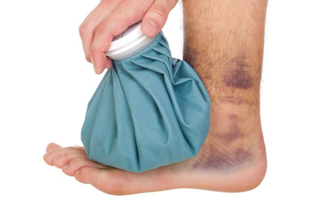 Contusiones: causas, síntomas, diagnóstico y tratamiento - La Guía de ...