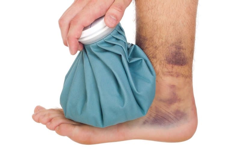 Contusiones: causas, síntomas, diagnóstico y tratamiento - La Guía de ...