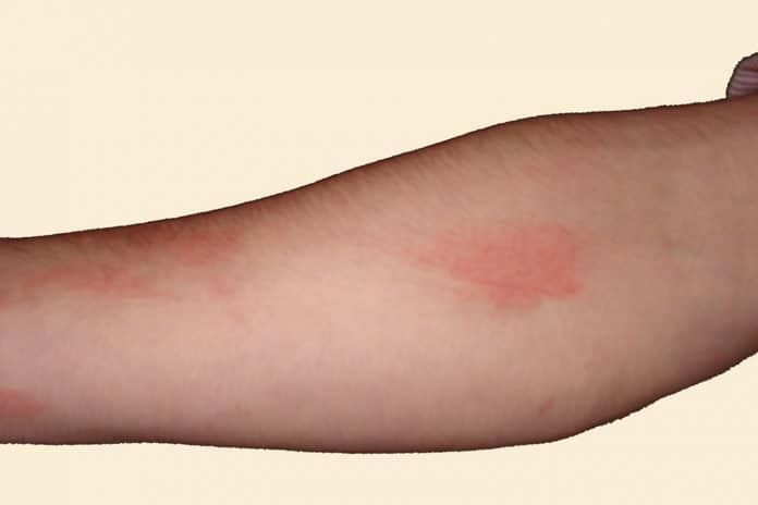 Contusiones: causas, síntomas, diagnóstico y tratamiento - La Guía de ...