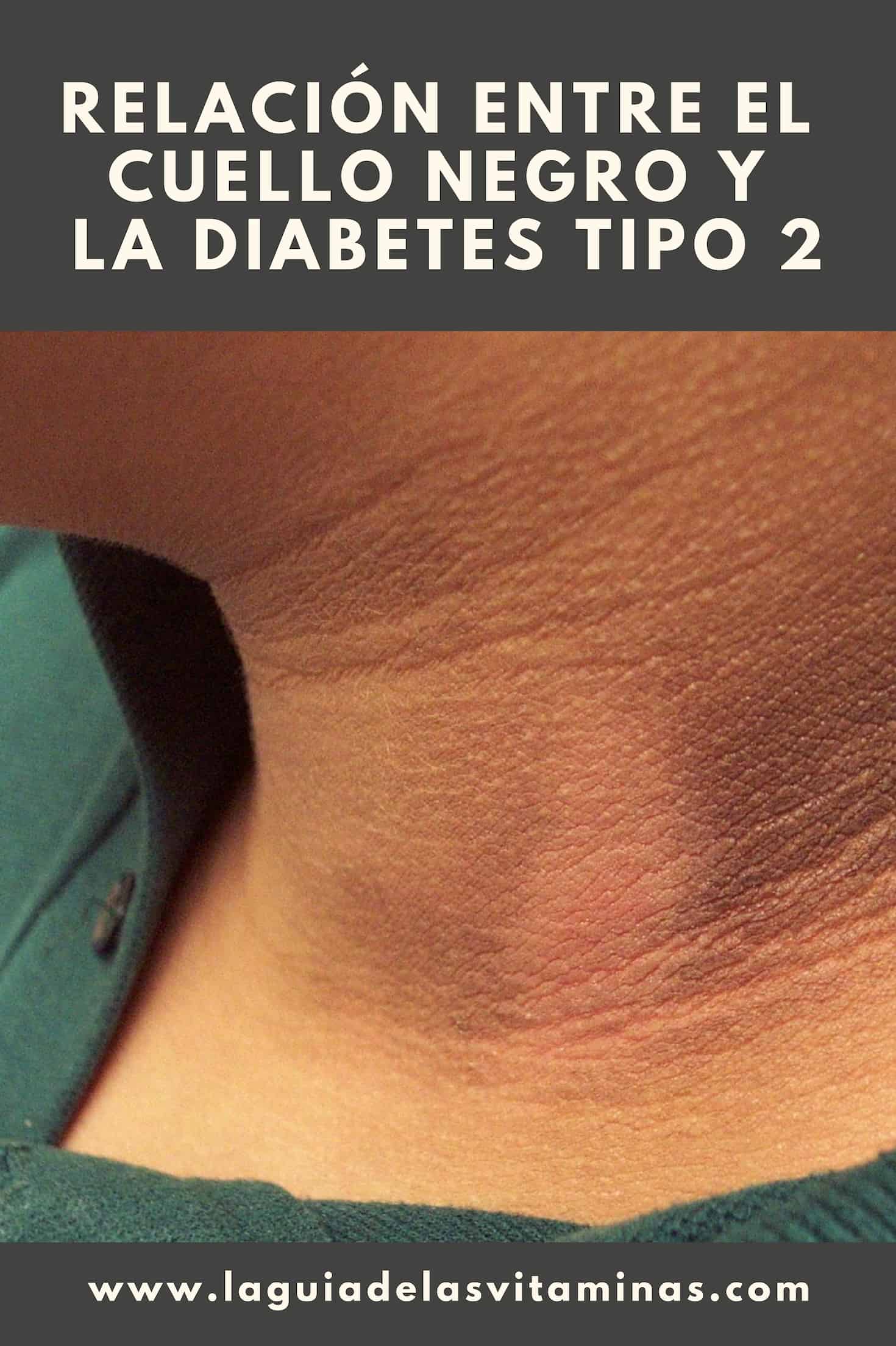 ¿El cuello negro o negruzco significa que tienes diabetes tipo 2? - La ...