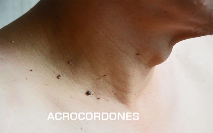 Diferencias entre verrugas y acrocordones: ¿Cómo distinguirlos? - La ...