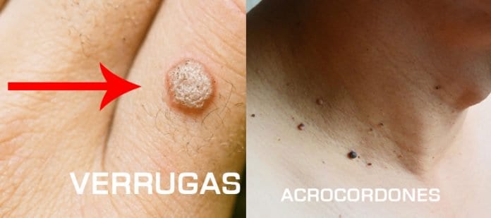Diferencias entre verrugas y acrocordones: ¿Cómo distinguirlos? - La ...